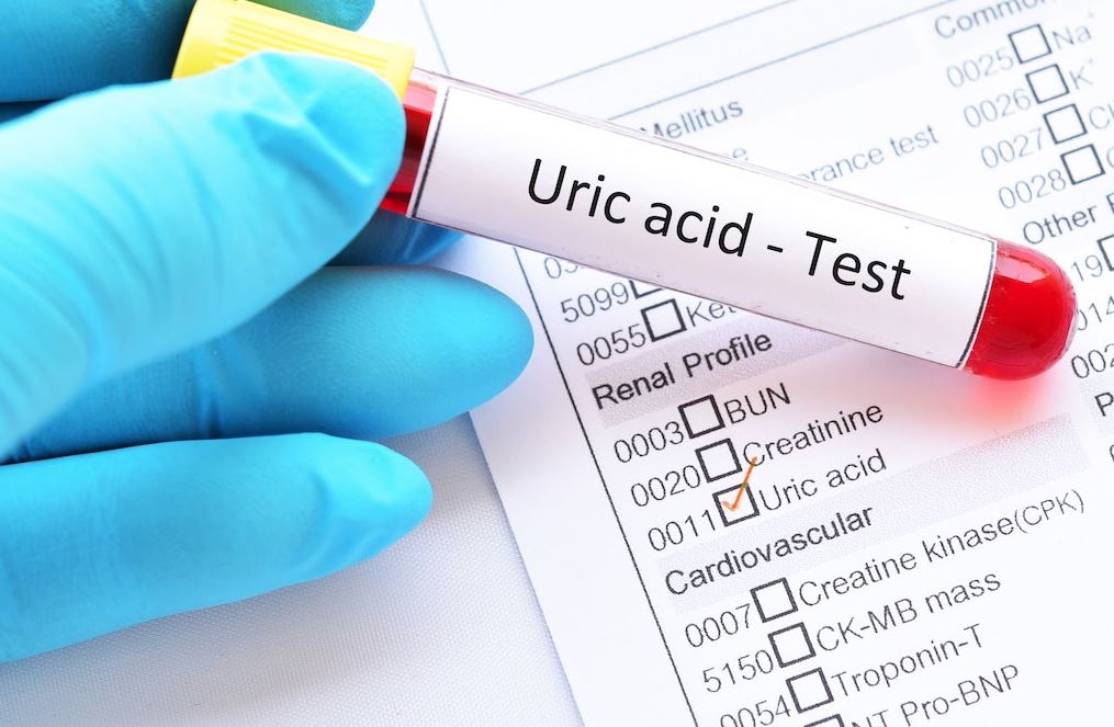 How is Gout Diagnosed? Blood Tests, Imaging, and Joint Fluid Analysis